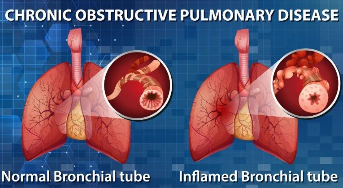 Pulmonary Rehabilitation - Memorial Health System